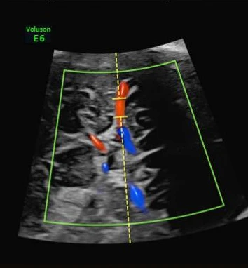 Ultrassom obstétrico com Doppler colorido – Dra. Marcela Xavier